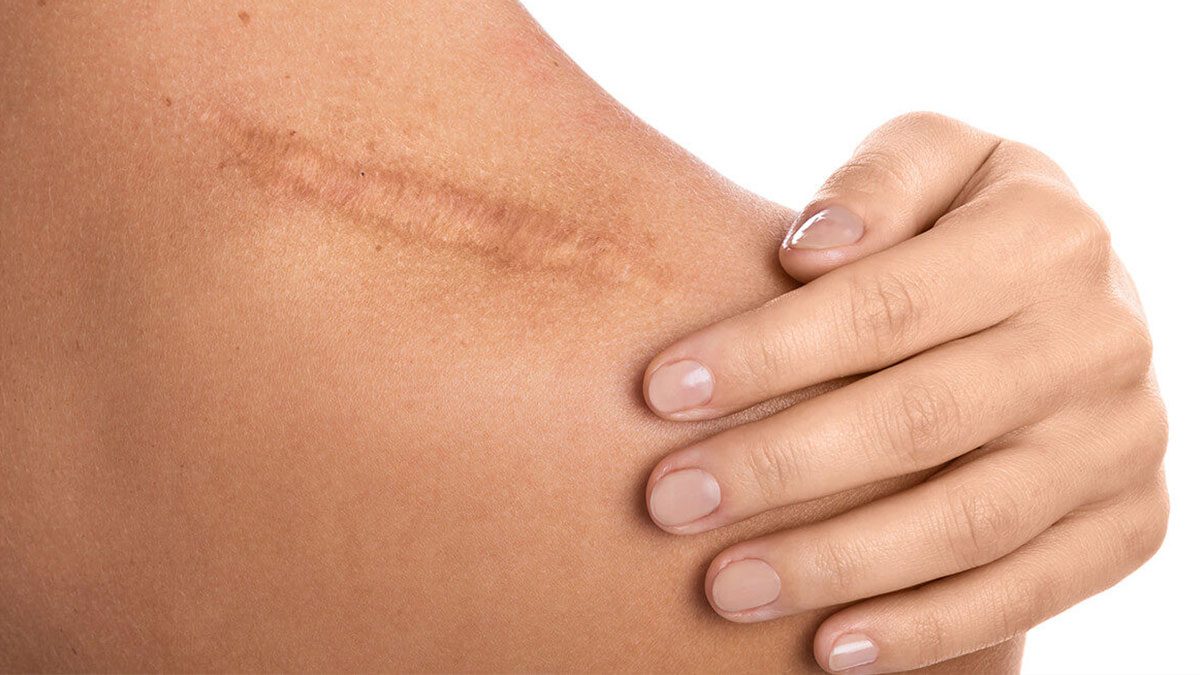 Como remover cicatriz com um creme caseiro que vai refrescar sua pele