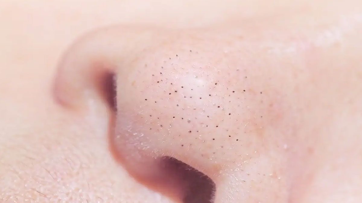 Acabe com cravos no nariz e rosto com essa alternativa caseira